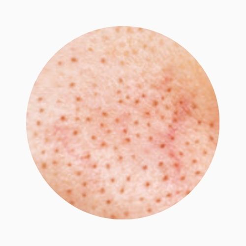 Blackheads – Mavk Cosmetics
